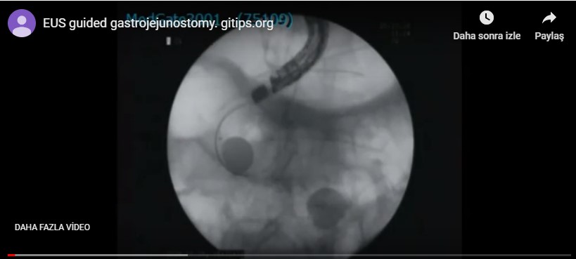 EUS guided gastrojejunostomy Gitips.org EUS guided gastrojejunostomy Gitips.org