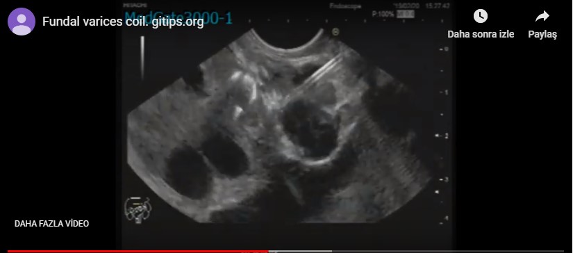 Eus Guided Coil And Glue Injection Treatment For Fundal Variceal